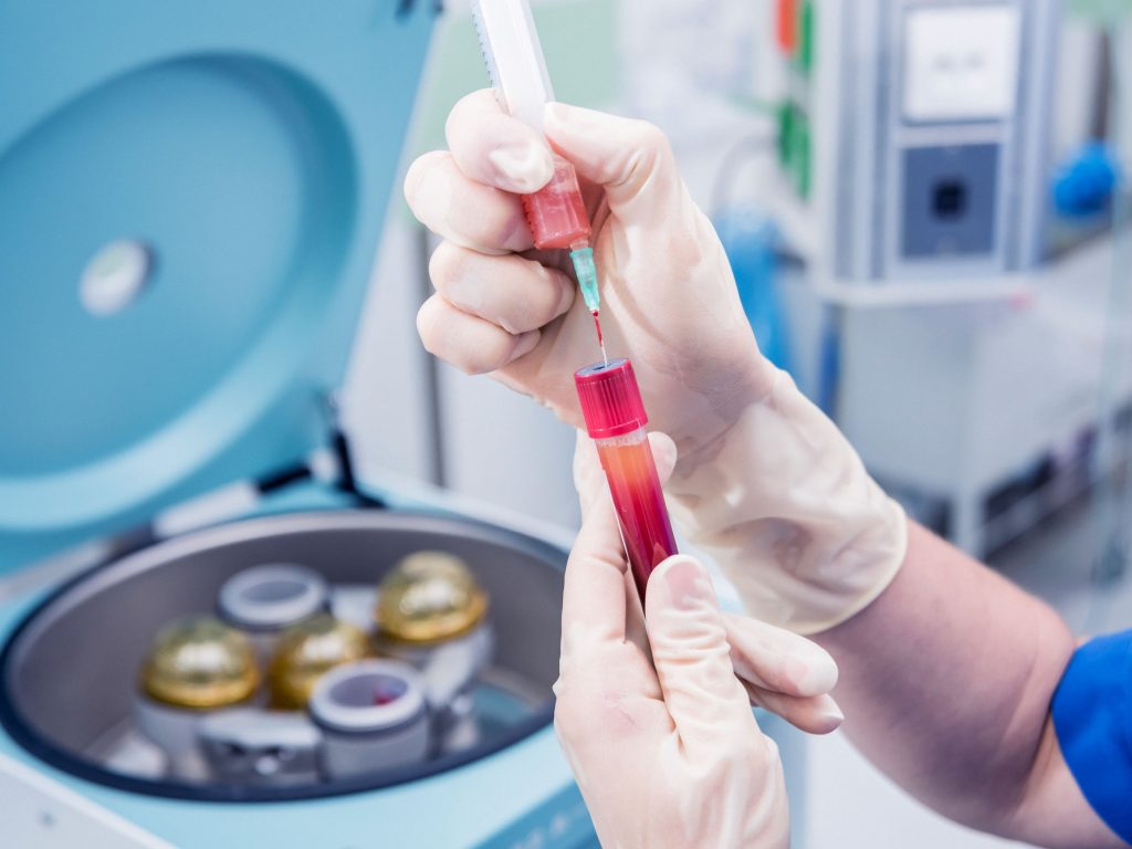 Tips to Find the Best Platelet Rich Plasma Kit